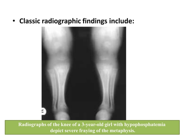 rickets.pptx | Bone and Joint Conditions | Diseases and Conditions
