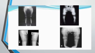 various types of rickets in pediatrics and its diagnosis and treatment.pptx