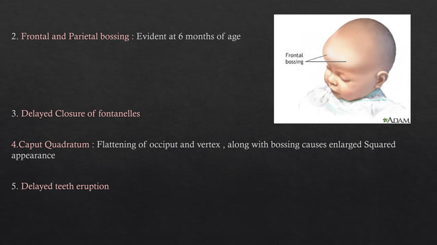 RICKETS - Clinical features, radiological features, classification ...