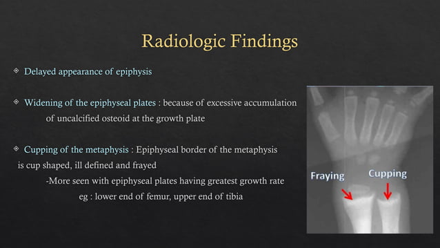 RICKETS - Clinical features, radiological features, classification ...