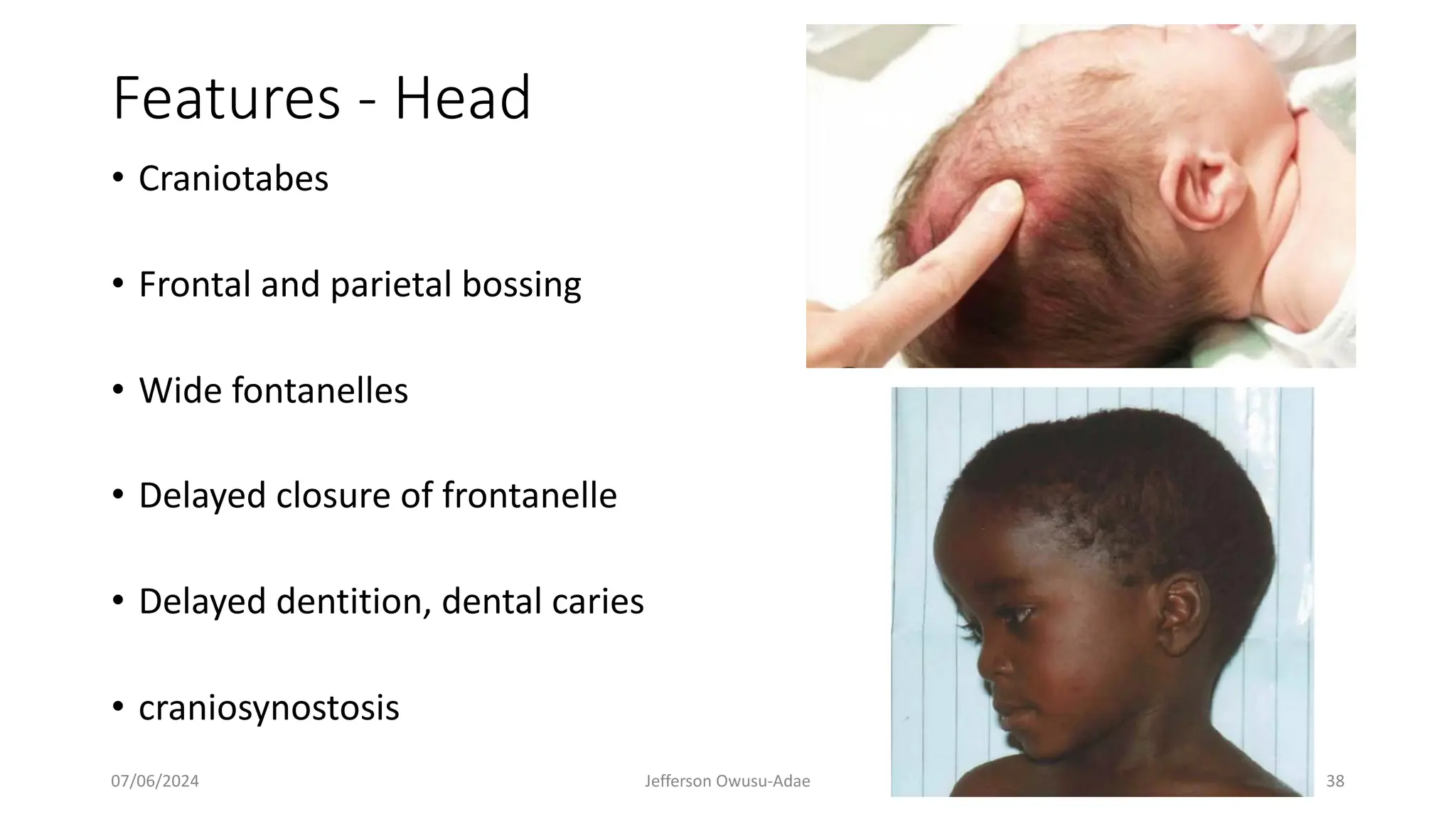 General Overview of Rickets by Dr. JOA- KBTH.pdf | Free Download