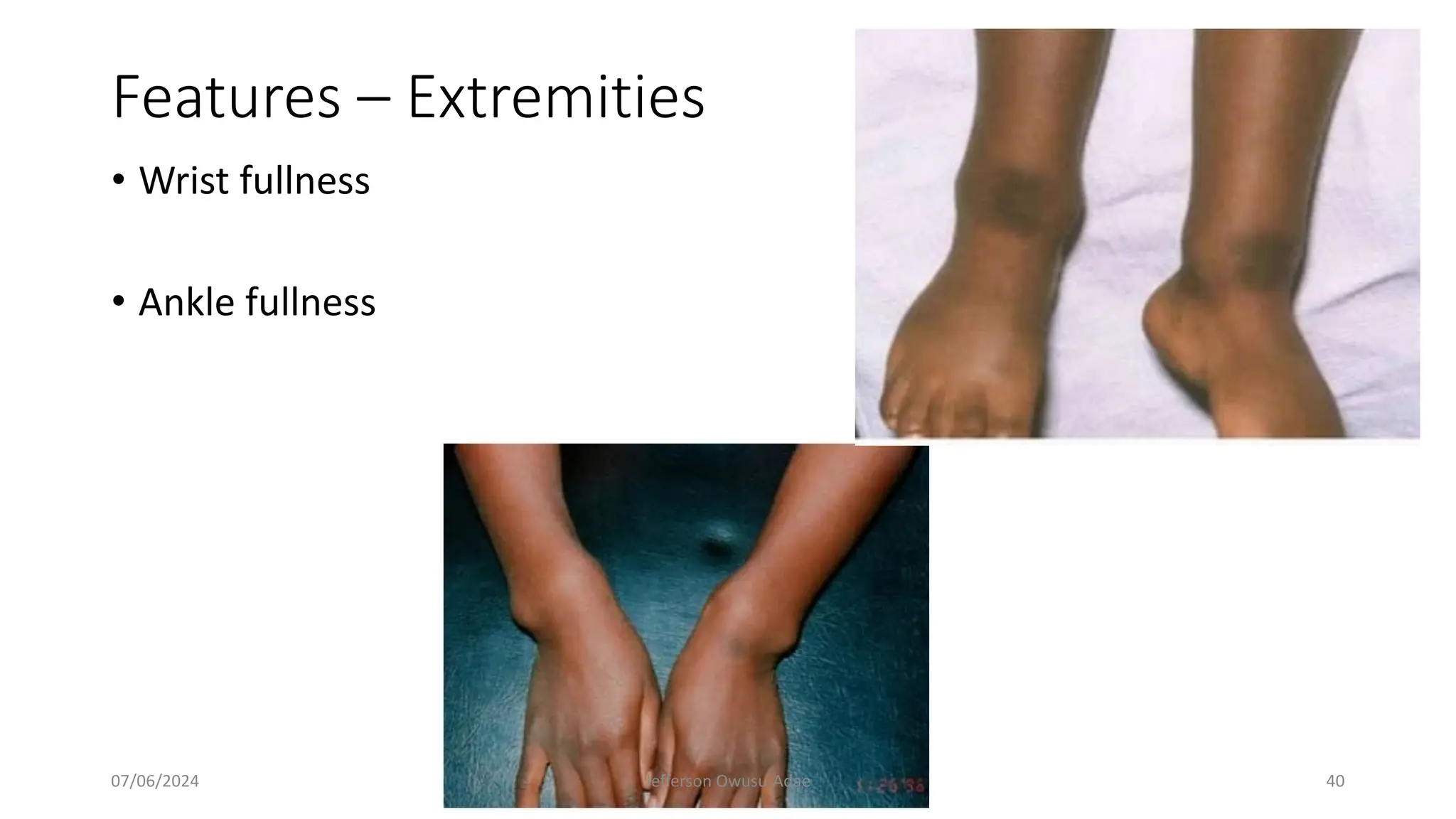 General Overview of Rickets by Dr. JOA- KBTH.pdf | Free Download