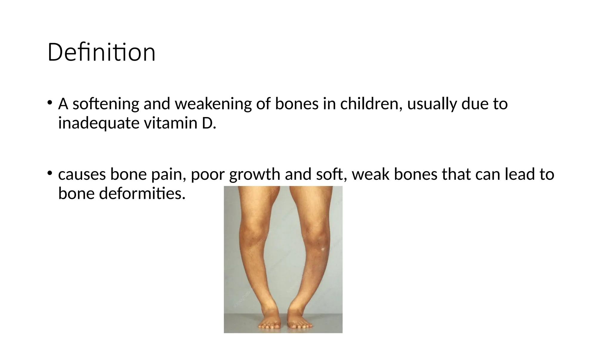 RICKETS : introduction, clinical features, Diagnosis, PT mangement | PPT