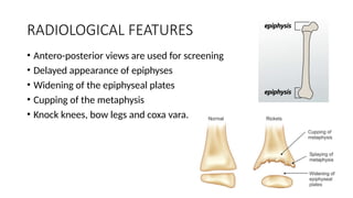 RICKETS : introduction, clinical features, Diagnosis, PT mangement | PPTX