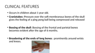 RICKETS : introduction, clinical features, Diagnosis, PT mangement | PPT