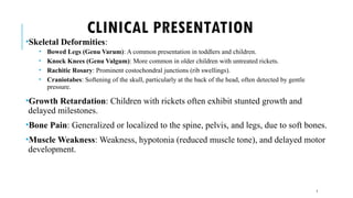 RICKETS AND THE PHYSIOTHERAPY TREATMENT.pptx