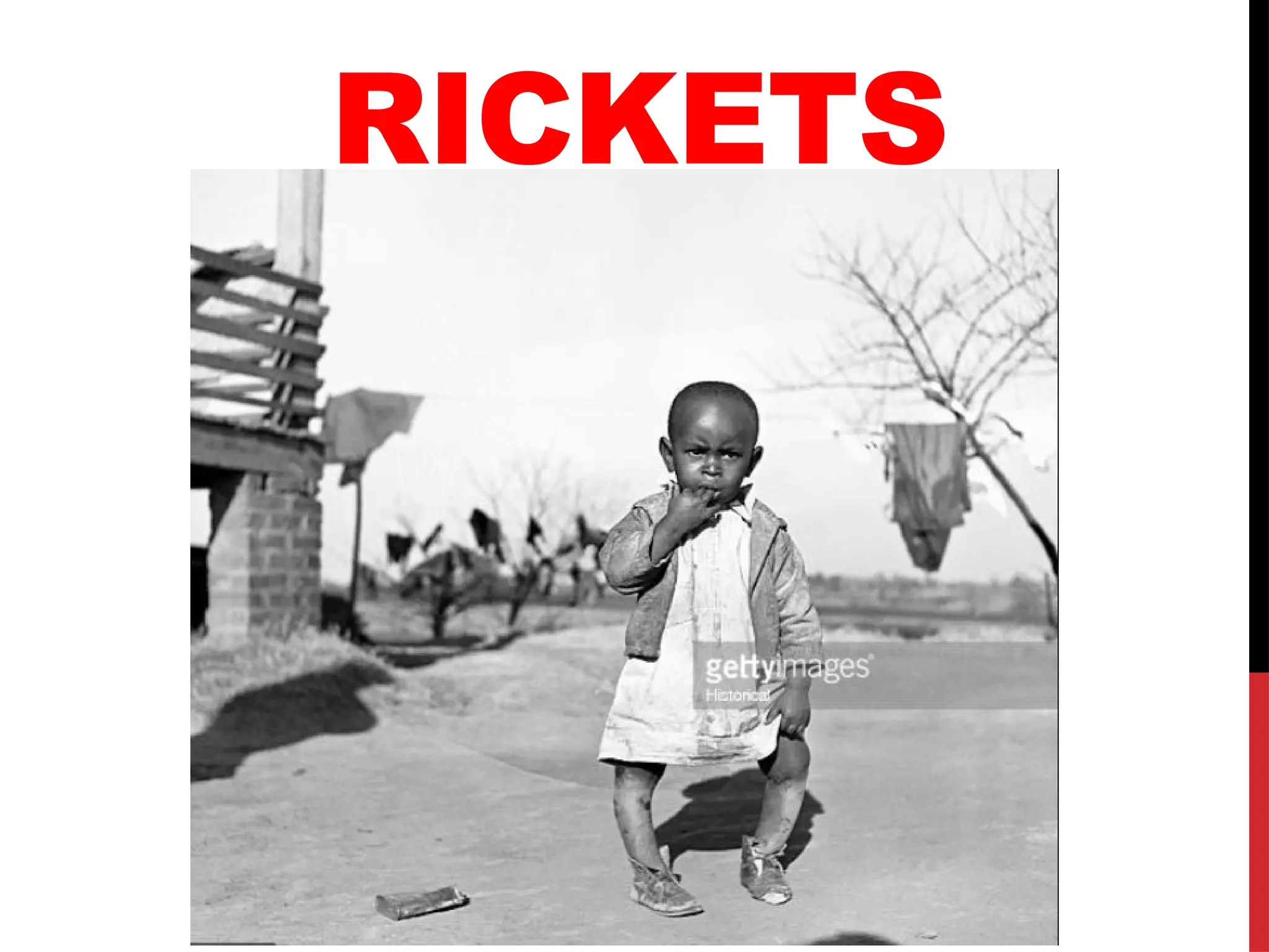 Rickets lecture for medical students.pptx