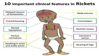 RICKETS.pptx calcium parathyroid hormone deficiency | PPT