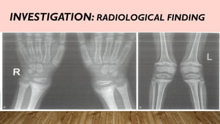 RICKETS.pptx calcium parathyroid hormone deficiency | PPT