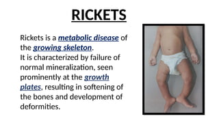 RICKETS manifestations of rocket and its management | PPTX