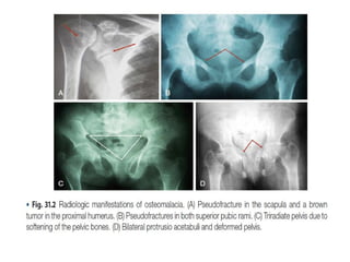 Triradiate Pelvis Osteomalacia