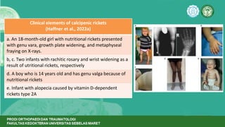 Rickets - Current Concept Review FK UNS. | PPTX