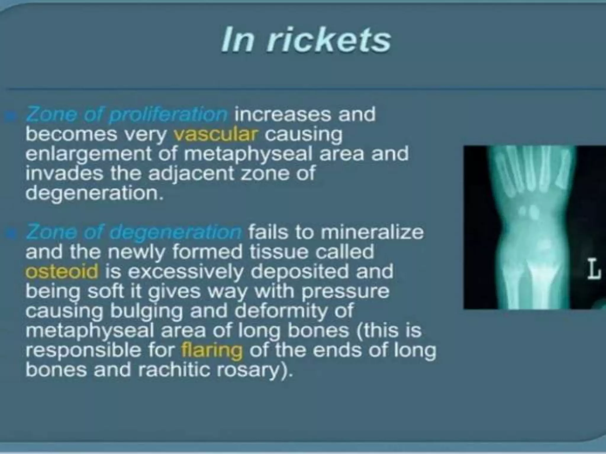 RICKETS -PPT.pptx