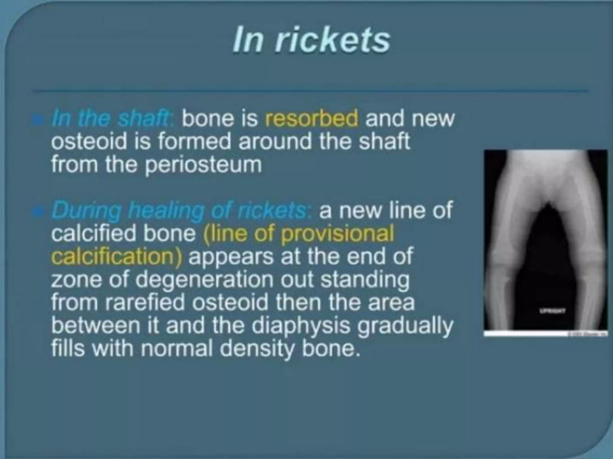 RICKETS -PPT.pptx