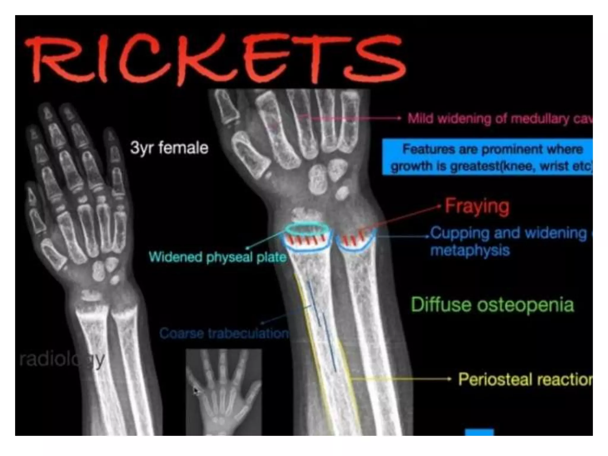 RICKETS -PPT.pptx