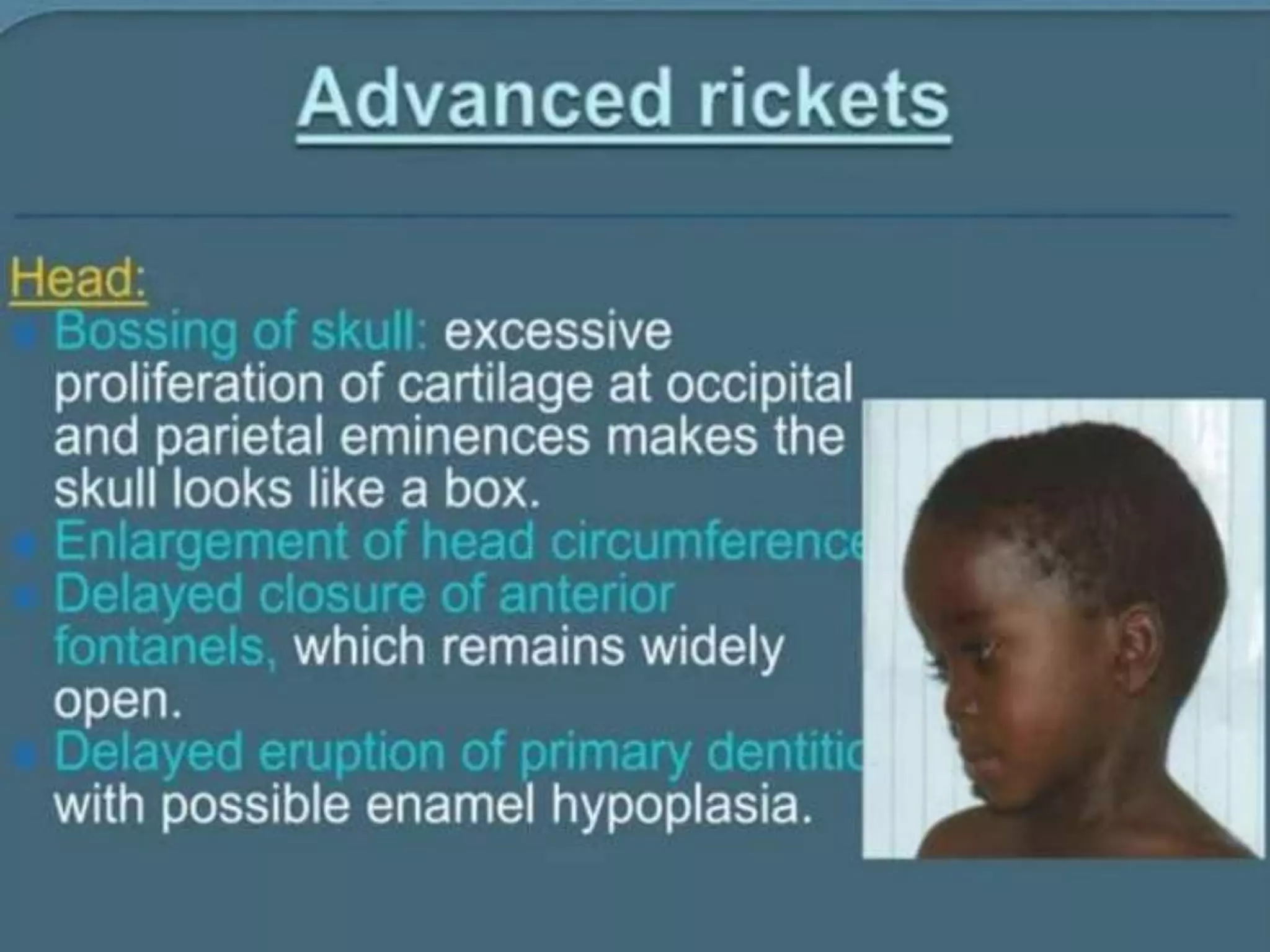 RICKETS -PPT.pptx