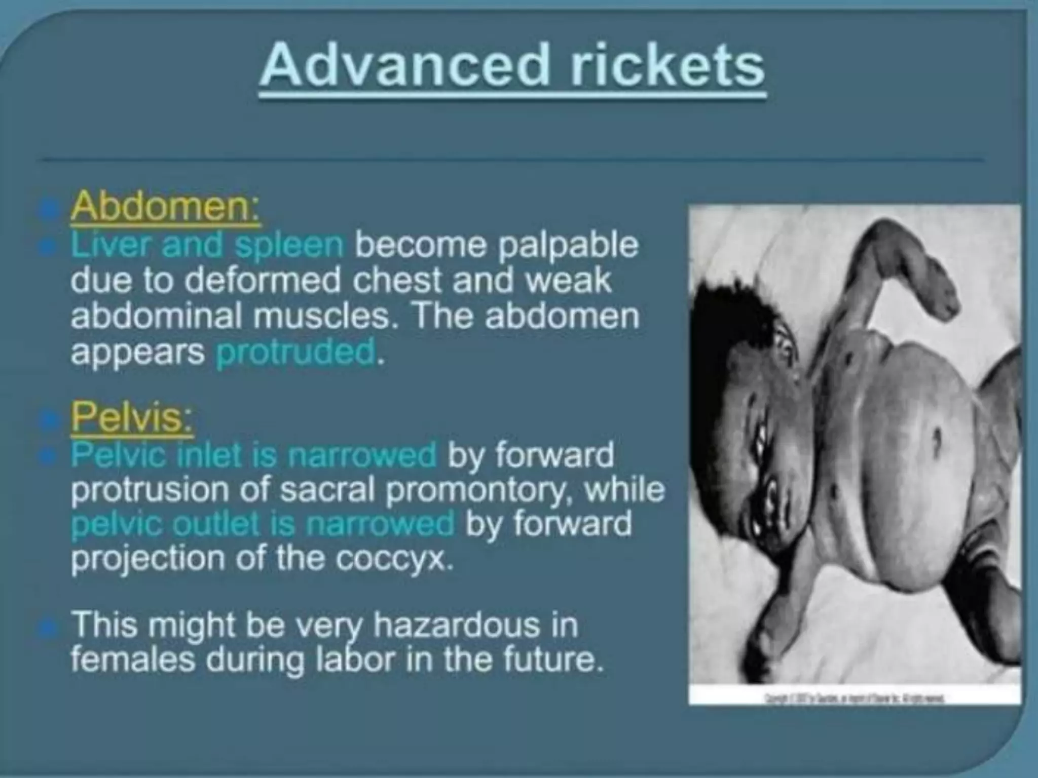 RICKETS -PPT.pptx