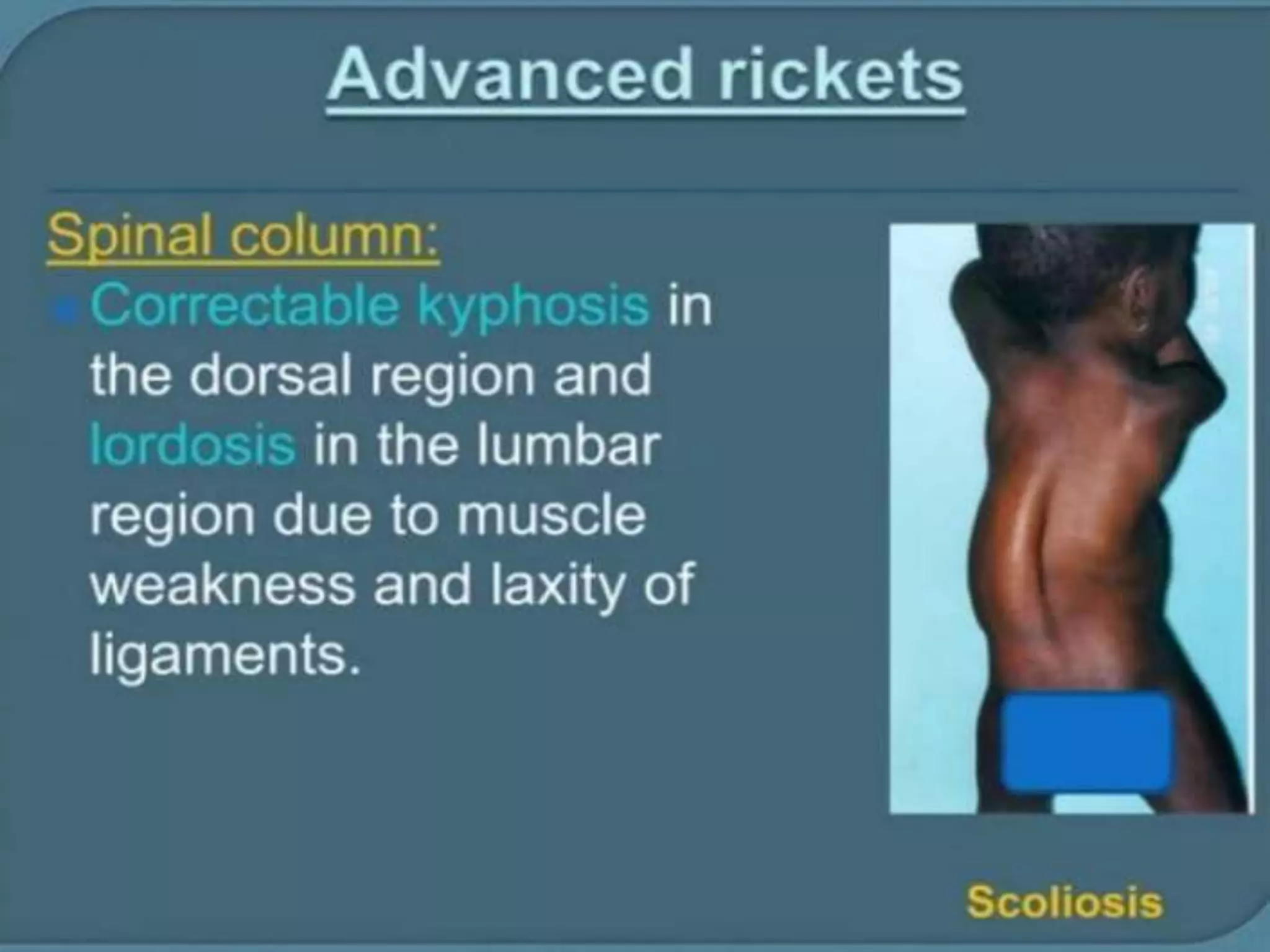 RICKETS -PPT.pptx