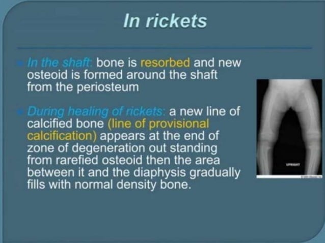 RICKETS -PPT.pptx