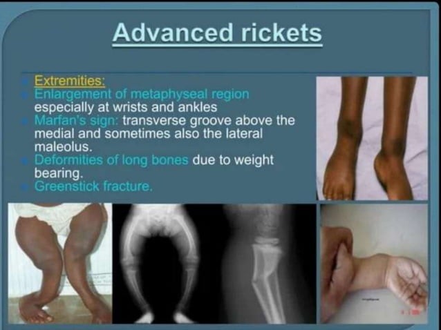 RICKETS -PPT.pptx