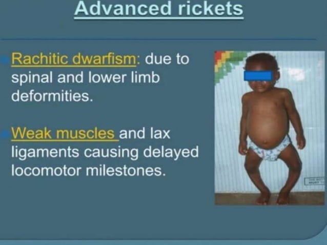 RICKETS -PPT.pptx