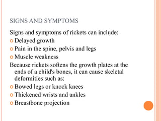 Rickets | PPTX