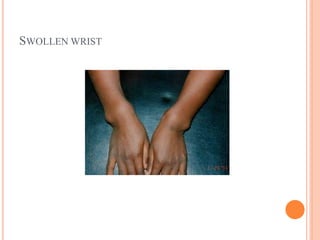 Rickets basics , pathology, diagnosis and management | PPTX