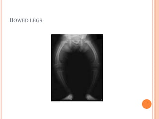 Rickets basics , pathology, diagnosis and management | PPTX