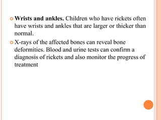 Rickets basics , pathology, diagnosis and management | PPTX