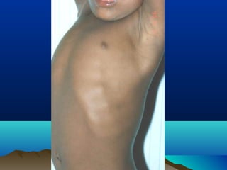 Pigeon Chest Rickets