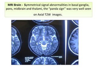Rickets and liver disease | PPT