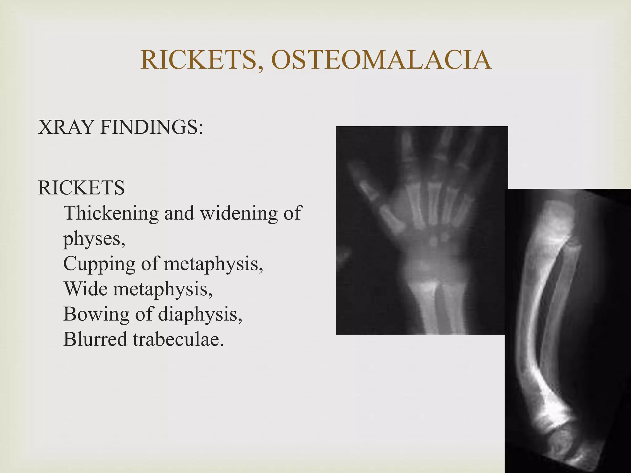 Rickets and osteomalacia | PPTX