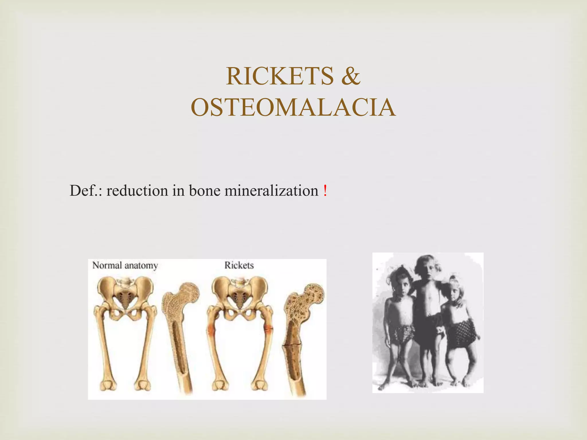 Rickets and osteomalacia | PPTX