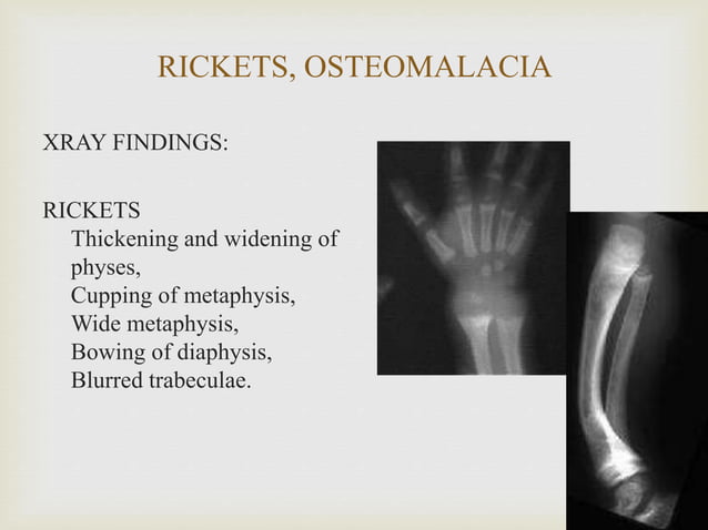 Rickets and osteomalacia | PPTX | Bone and Joint Conditions | Diseases ...