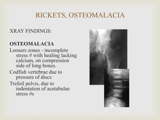 Rickets and osteomalacia | PPTX