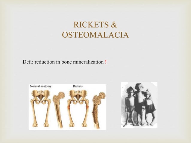 Rickets and osteomalacia | PPTX | Bone and Joint Conditions | Diseases ...