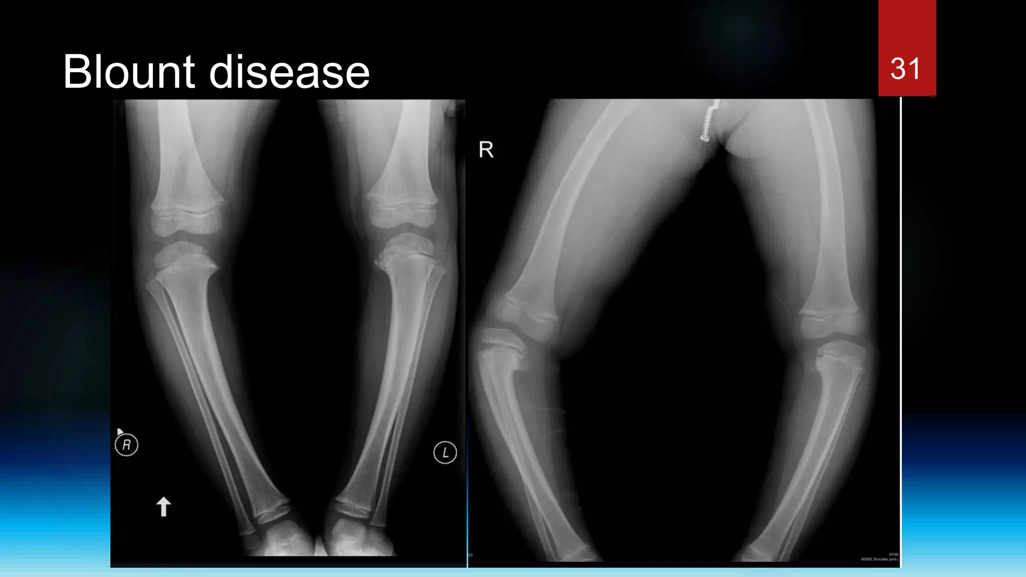 Rickets and osteomalacia | PPTX