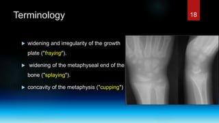 Rickets and osteomalacia | PPTX