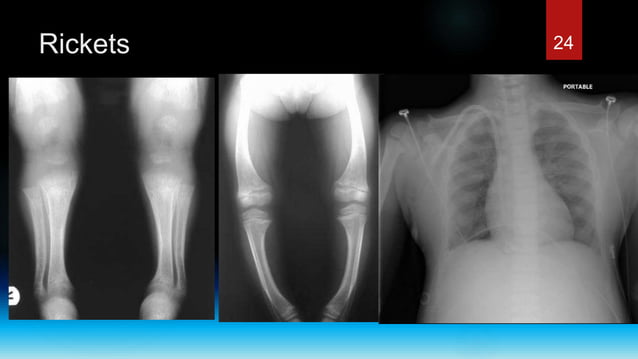 Rickets and osteomalacia | PPTX