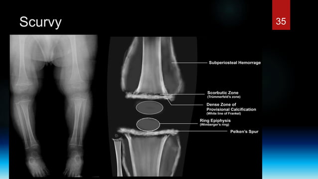 Rickets and osteomalacia | PPTX