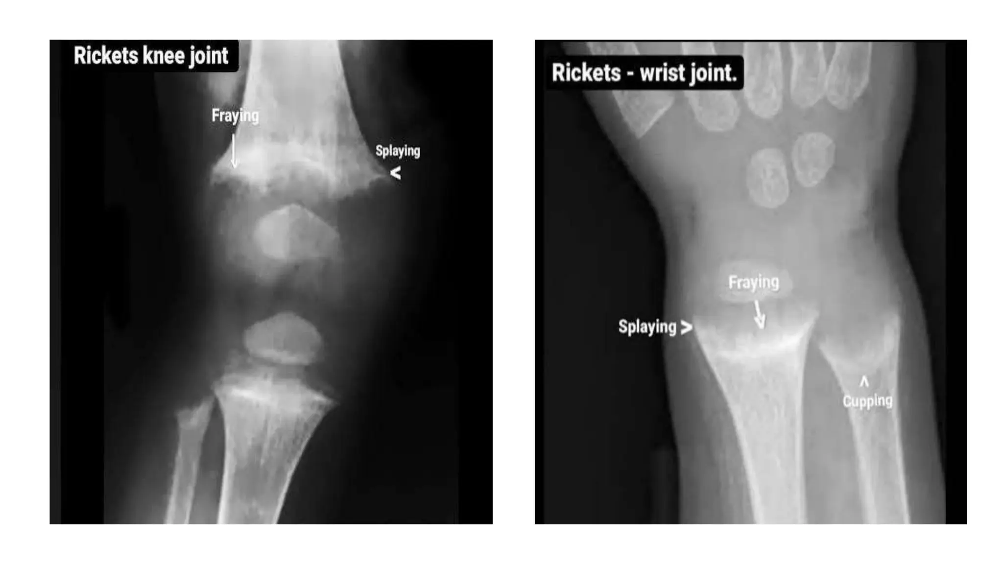 Rickets and osteomalacia presentation for postgarduate in orthopaedics ...