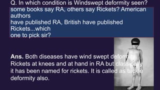 Rickets and osteomalacia by gk yadav | PPTX