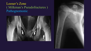Rickets and osteomalacia by gk yadav | PPTX