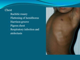 Pigeon Chest Rickets