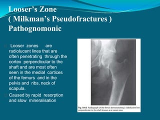 Rickets and osteomalacia | PPT