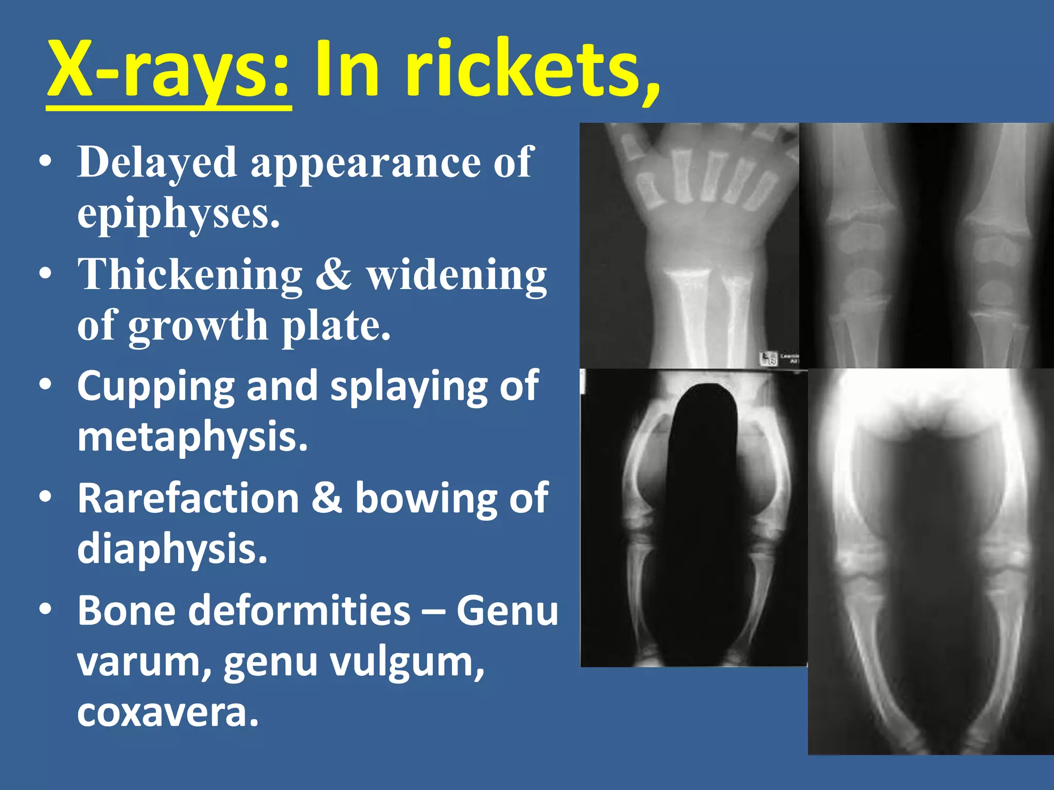 Rickets and osteomalacia,ppt | PPTX