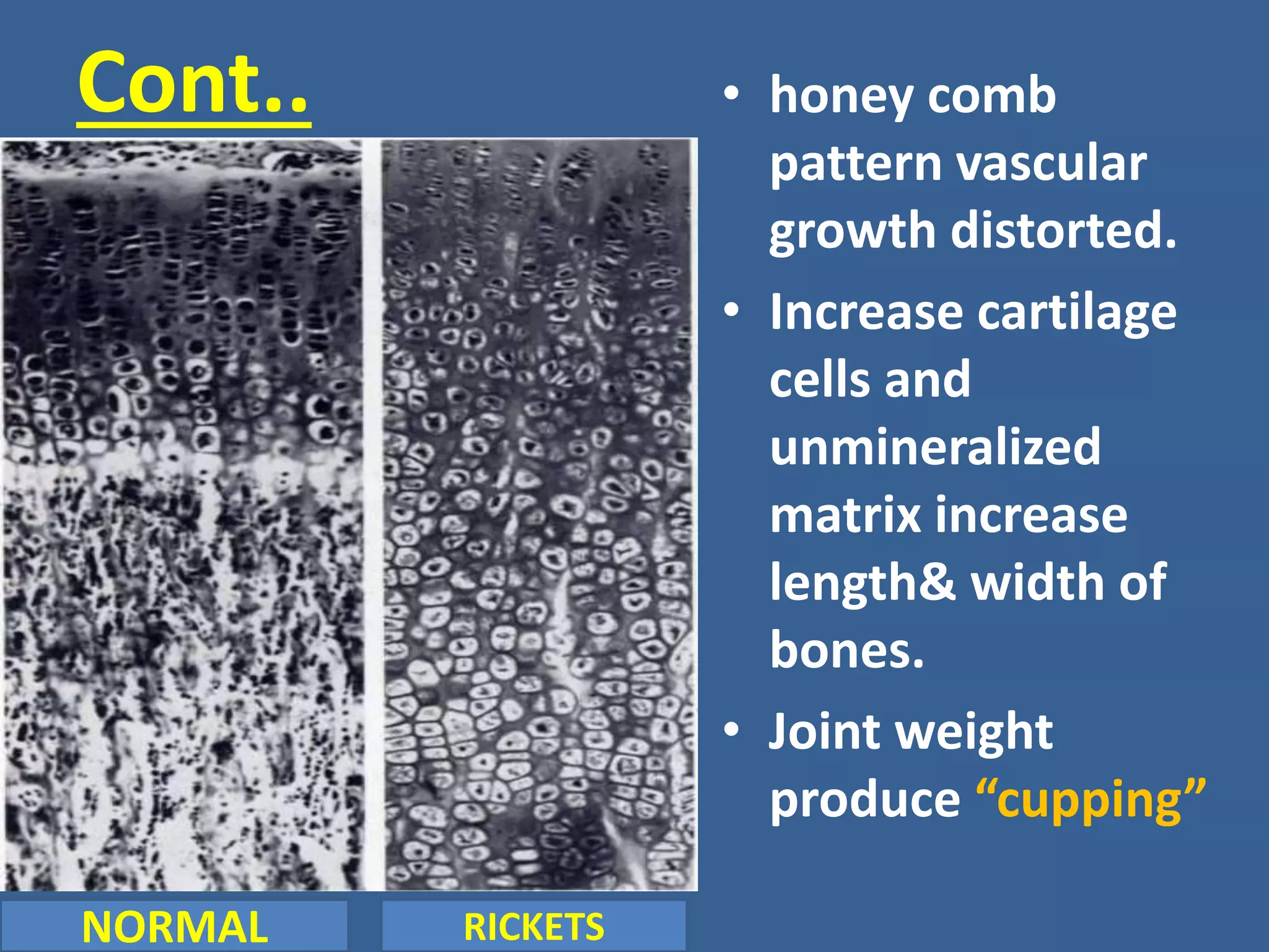 Rickets and osteomalacia,ppt | PPTX