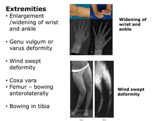 RICKETS.pptx
