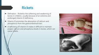 RICKETS HYPERVITAMIN, SPASMOPHILIA MANDEEP SINGH.pptx