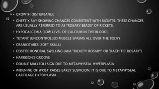 Rickets in children | PPTX